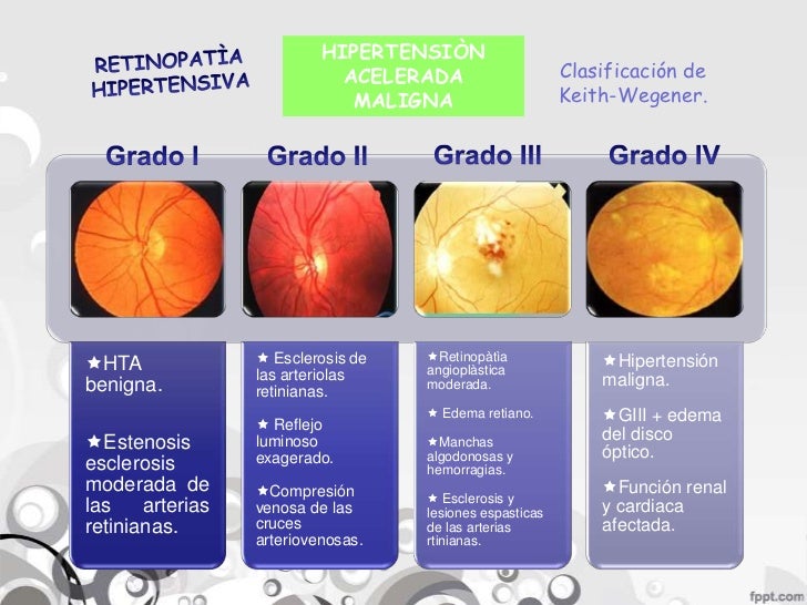 Urgencia y emergencia hipertensiva.