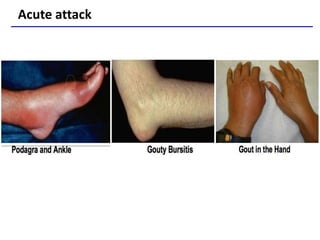 Uric acid disorders | PPTX | Digestive Disorders | Diseases and Conditions