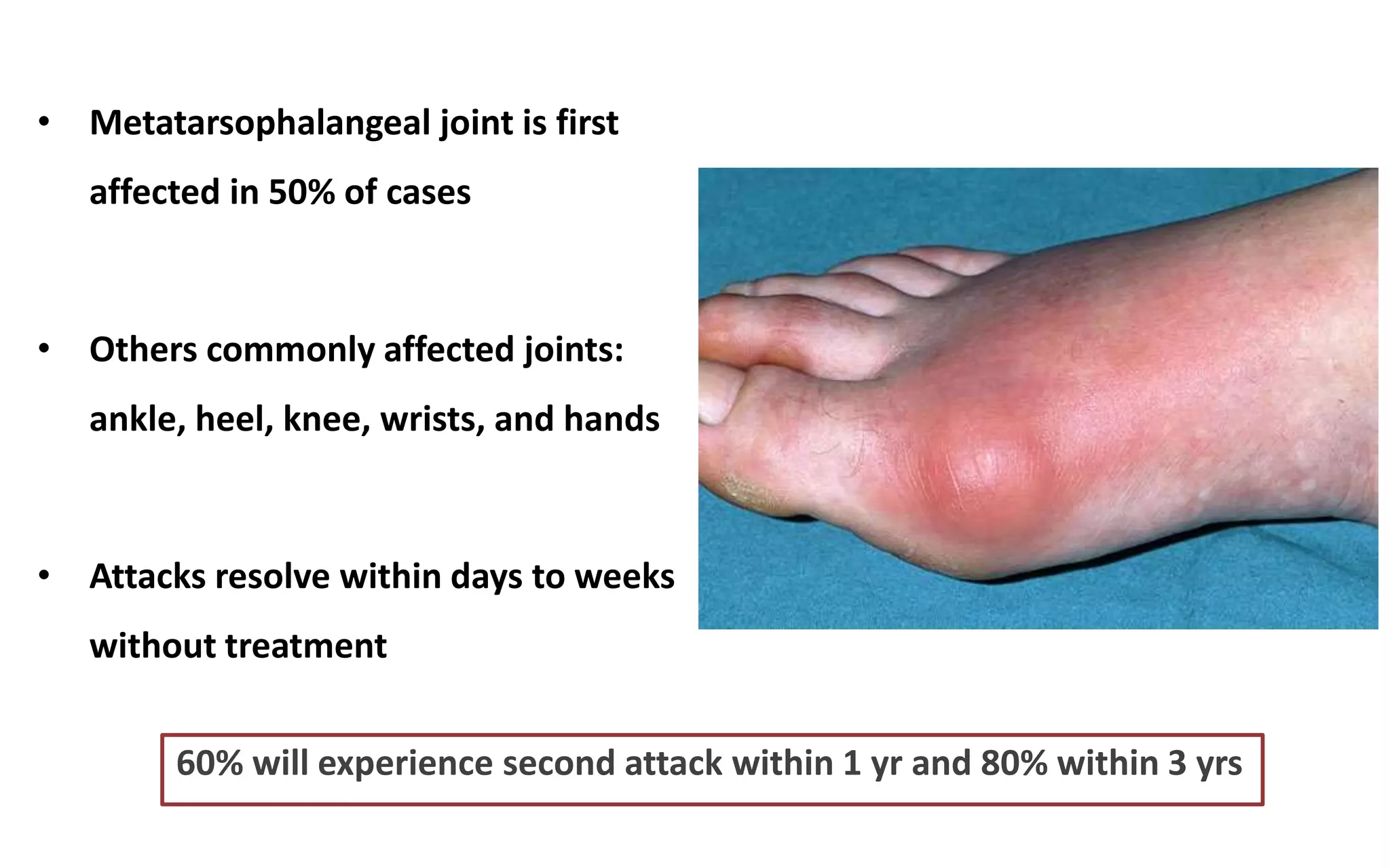 Uric acid metabolism and Gout | PPTX