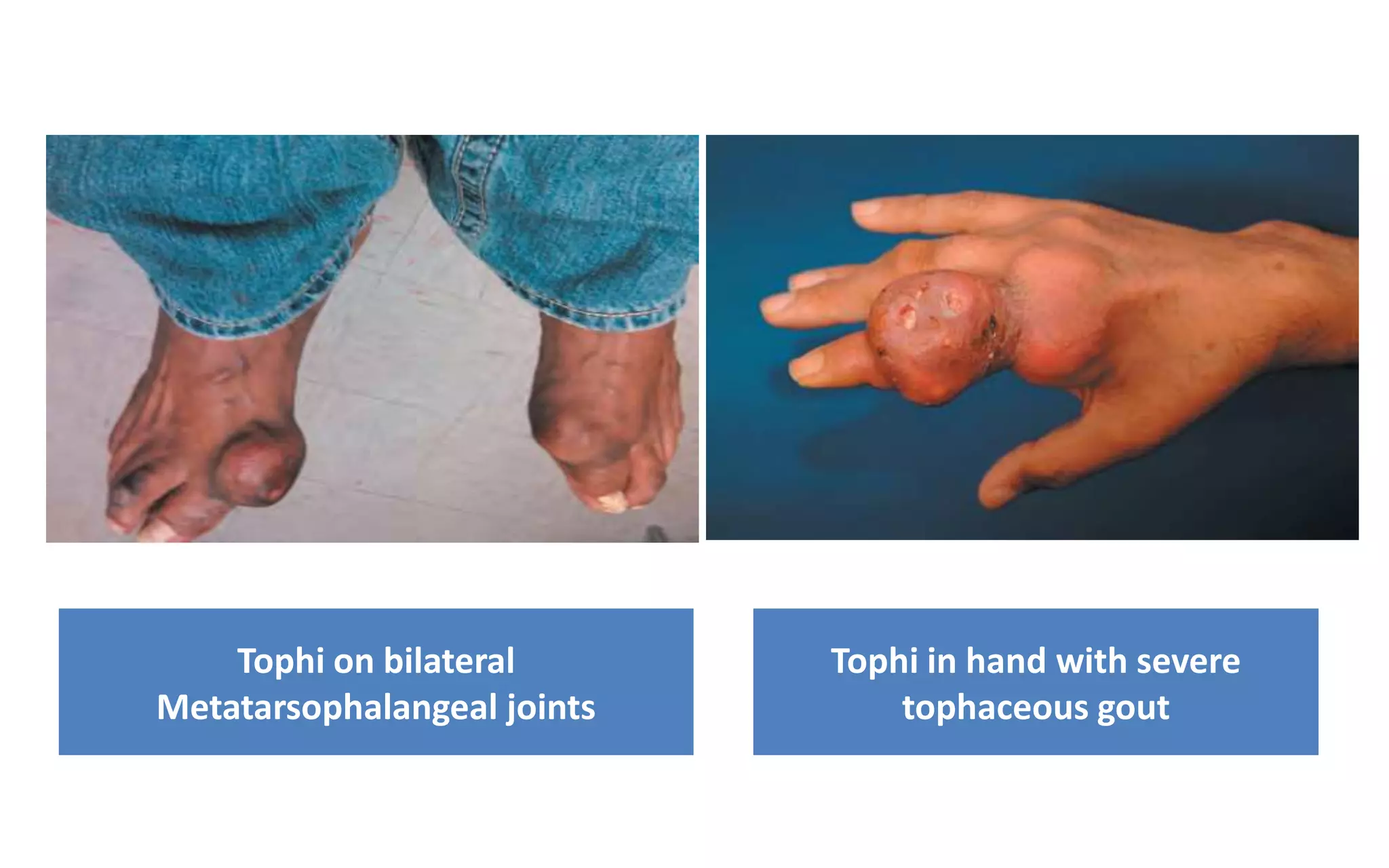 Uric acid metabolism and Gout | PPTX