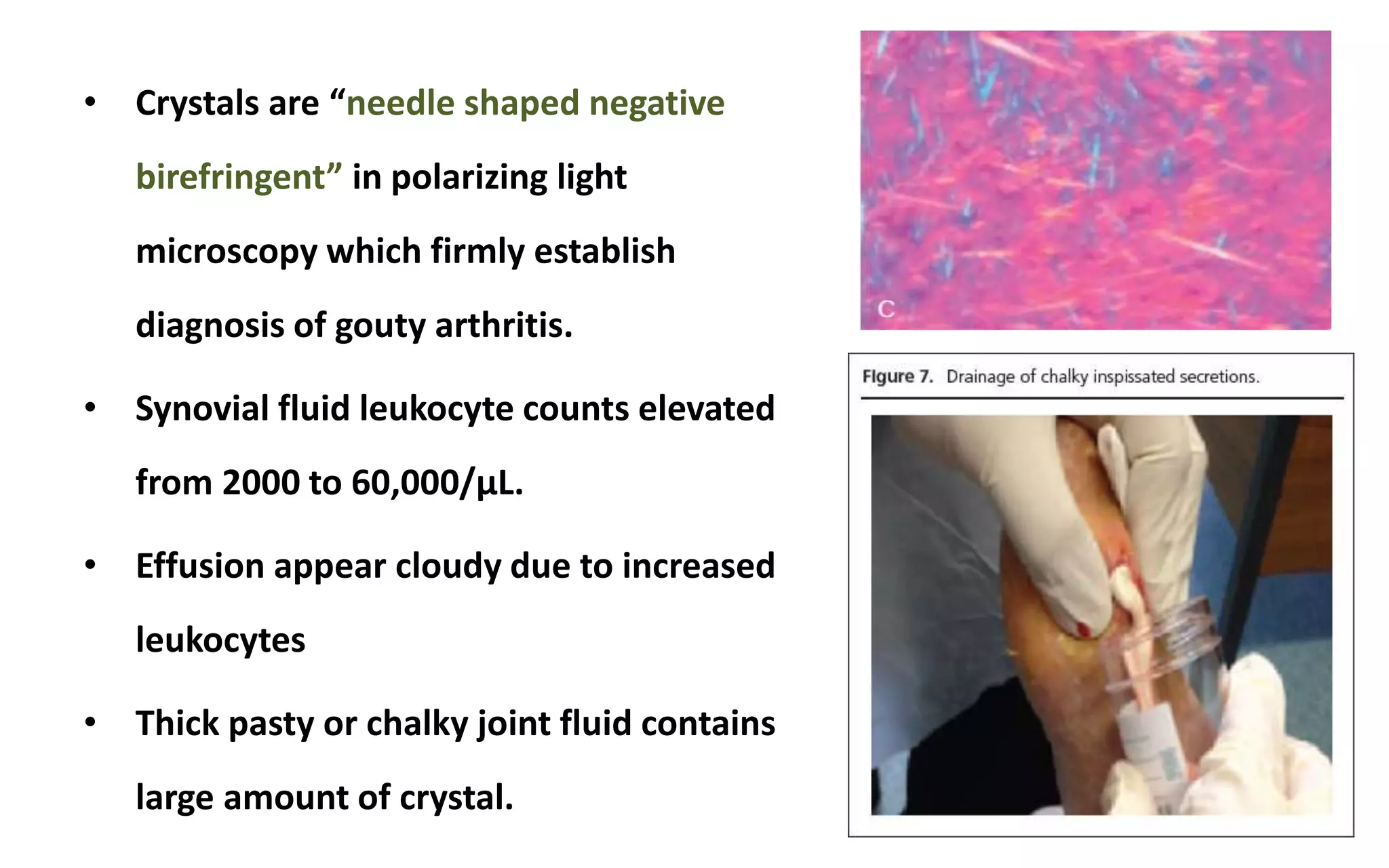 Uric acid metabolism and Gout | PPTX