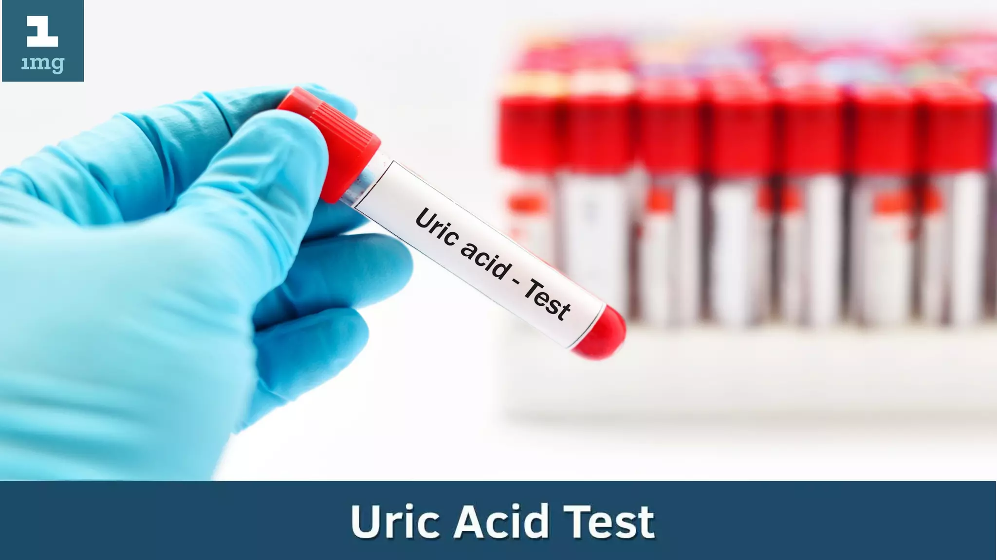 Uric acid test | ODP