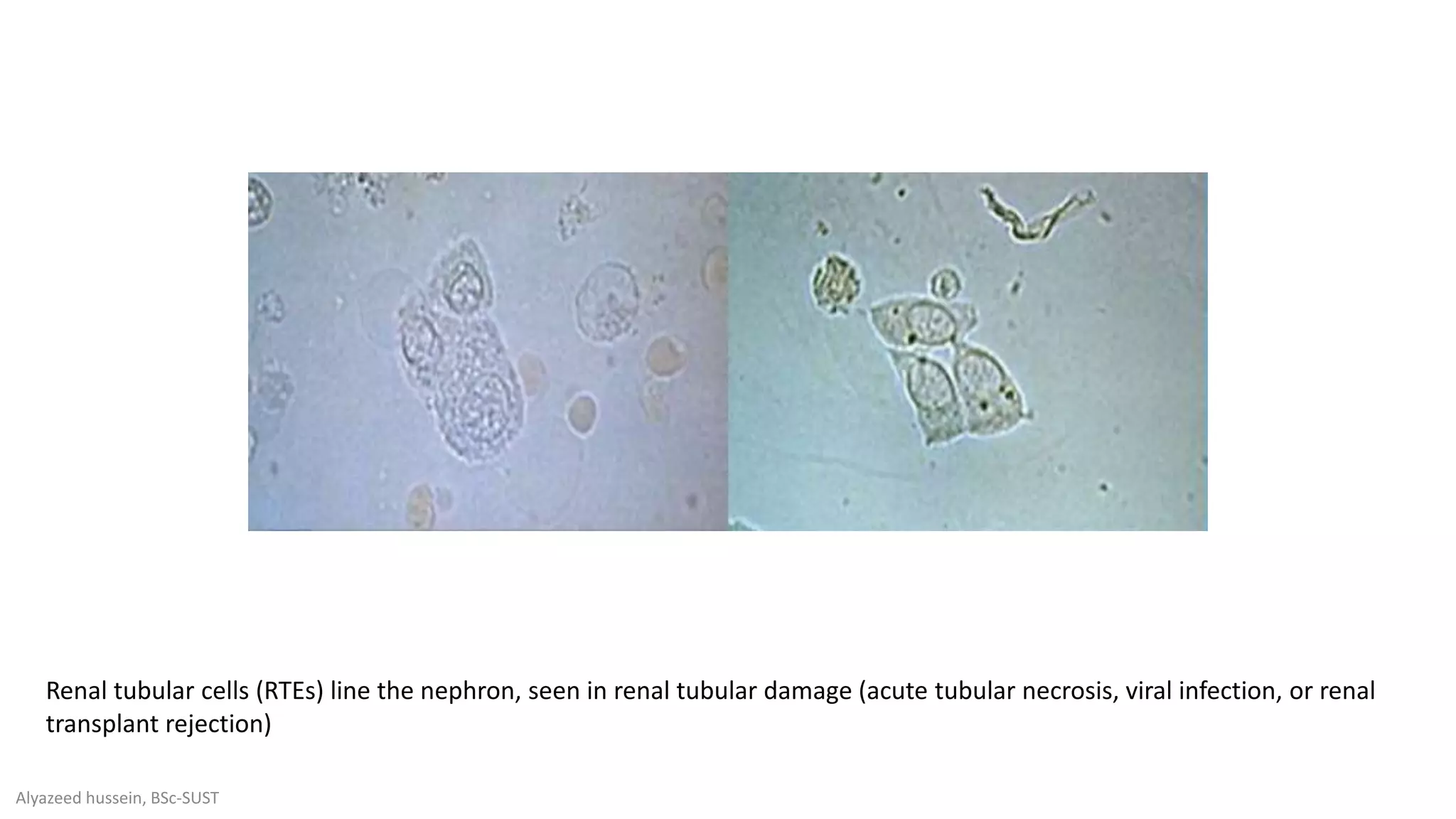 Urinalysis a comprehensive review | PPTX