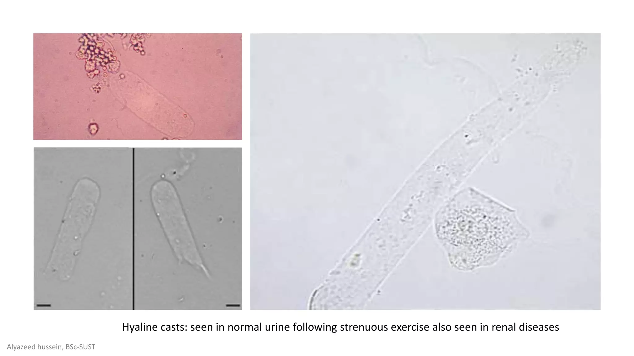 Urinalysis a comprehensive review | PPTX