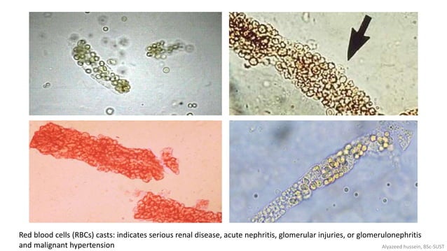 Urinalysis a comprehensive review | PPTX | Blood Disorders | Diseases ...
