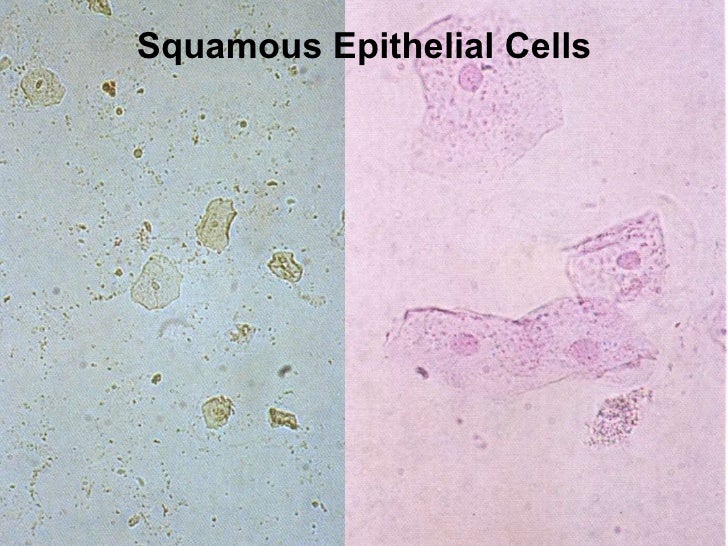 Epithelial Cells In Urine What Does It Mean If You Have 47 Off