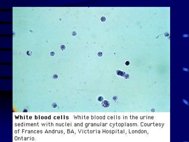 Urinalysis; urine examination in the lab.ppt | Blood Disorders ...