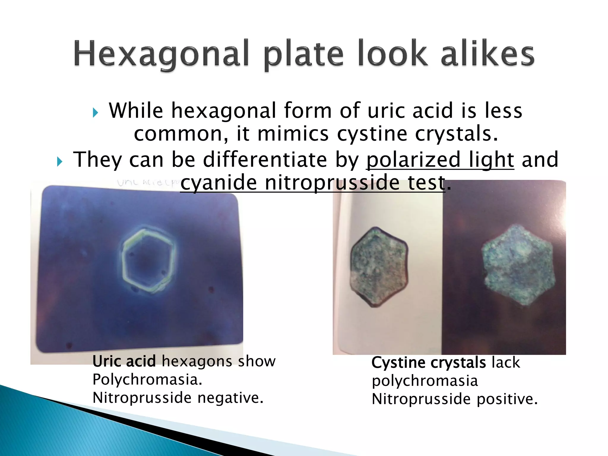 Urinalysis and body fluid crystals | PDF