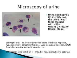 Urinalysis and body fluid crystals | PPT