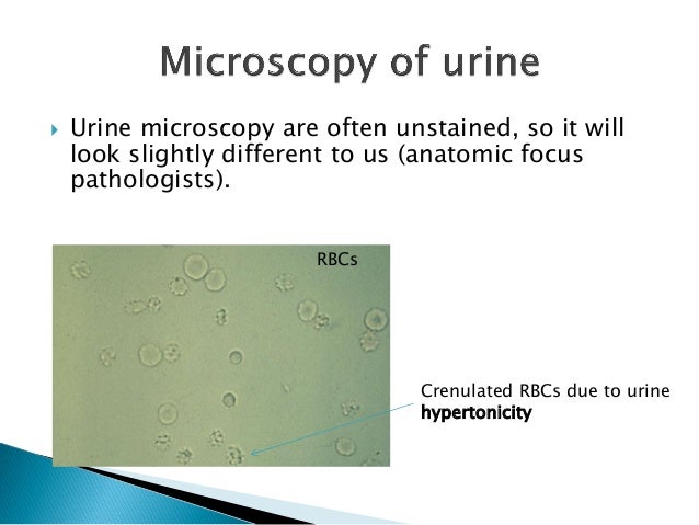 Urinalysis and body fluid crystals