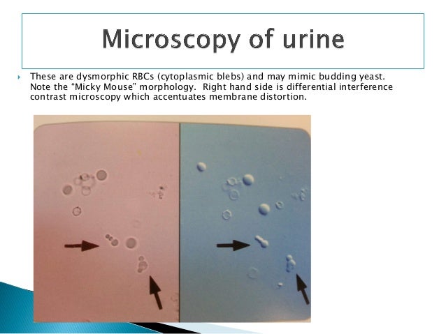 Urinalysis and body fluid crystals