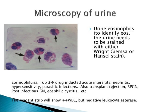 Urinalysis and body fluid crystals