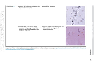 Urinalysis Interpretation and Clinical Correlations.pdf