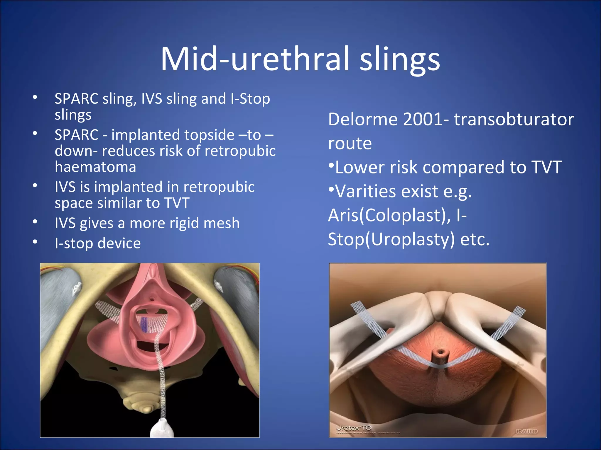 Urinary Incontinence Surgery | PPT