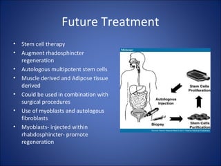 Urinary Incontinence Surgery | PPT