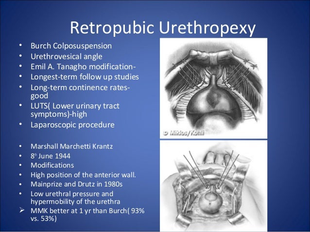 Urinary Incontinence Surgery