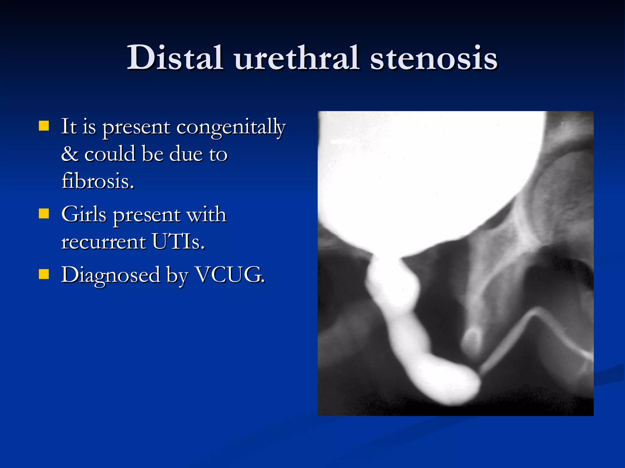 Urinary Outflow Obstruction | PPT