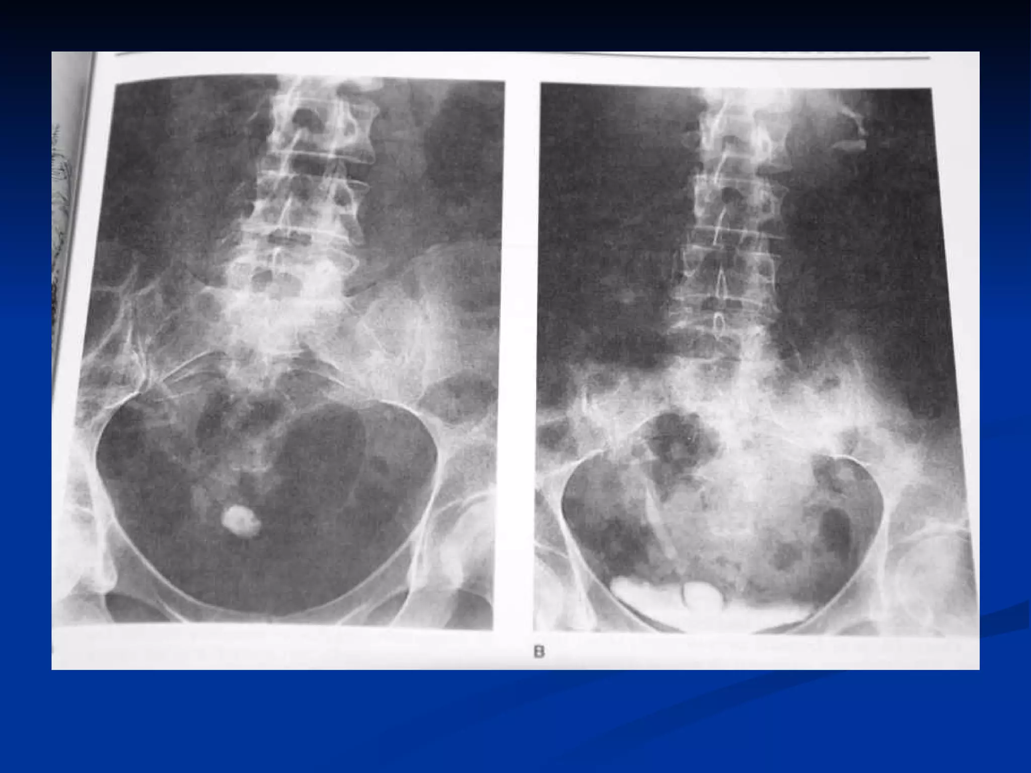Urinary Outflow Obstruction | PPT