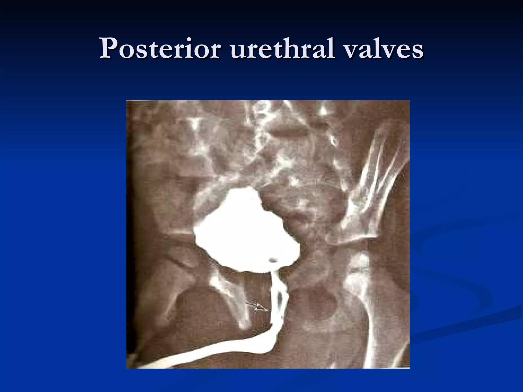 Urinary Outflow Obstruction | PPT