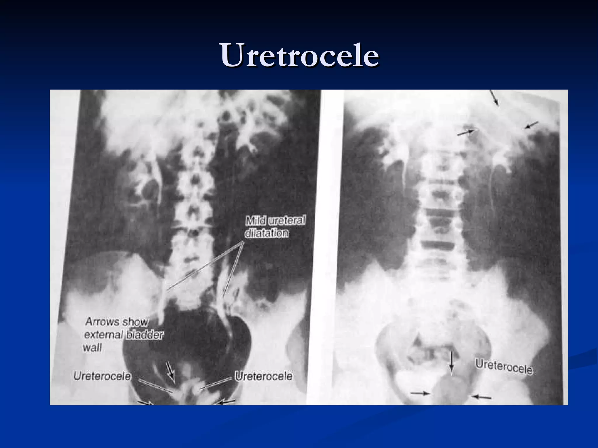 Urinary Outflow Obstruction | PPT