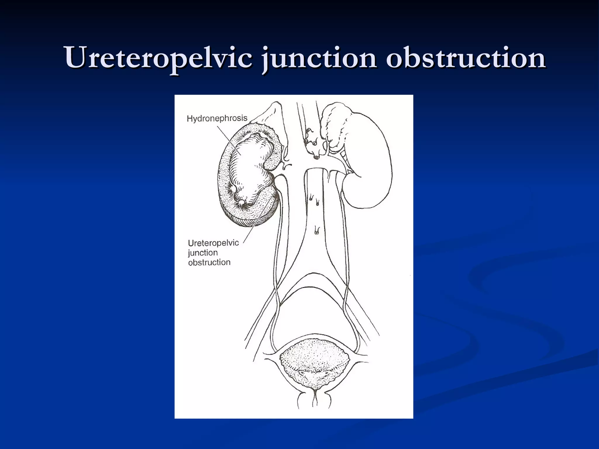 Urinary Outflow Obstruction | PPT