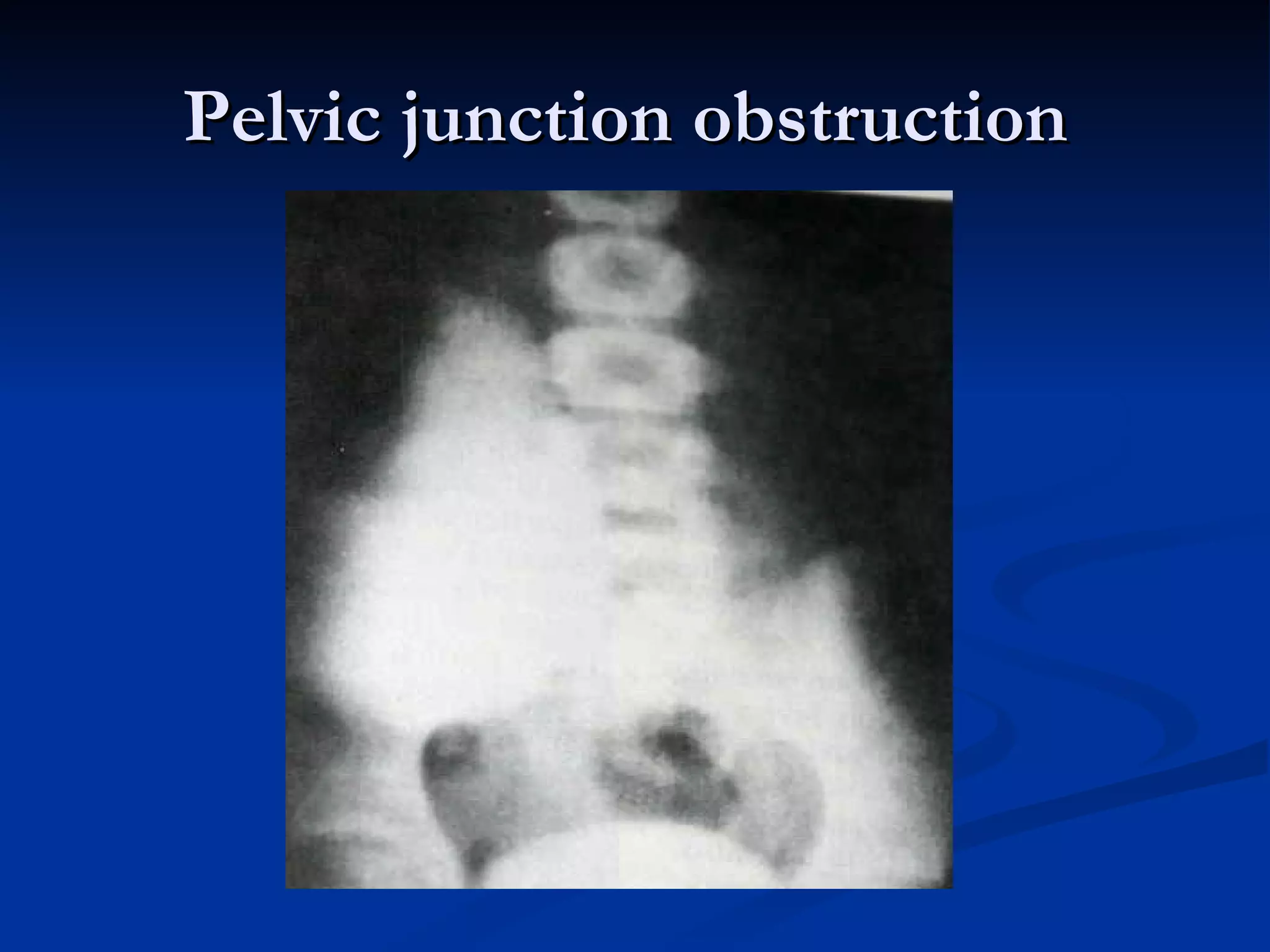 Urinary Outflow Obstruction | PPT