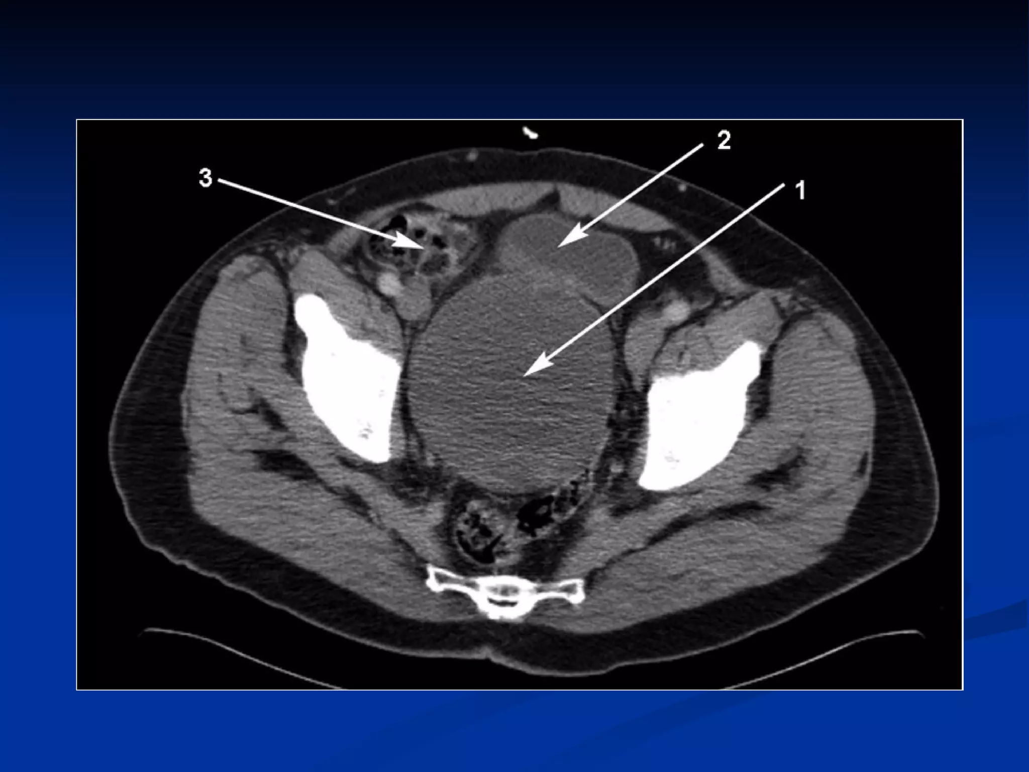 Urinary Outflow Obstruction | PPT