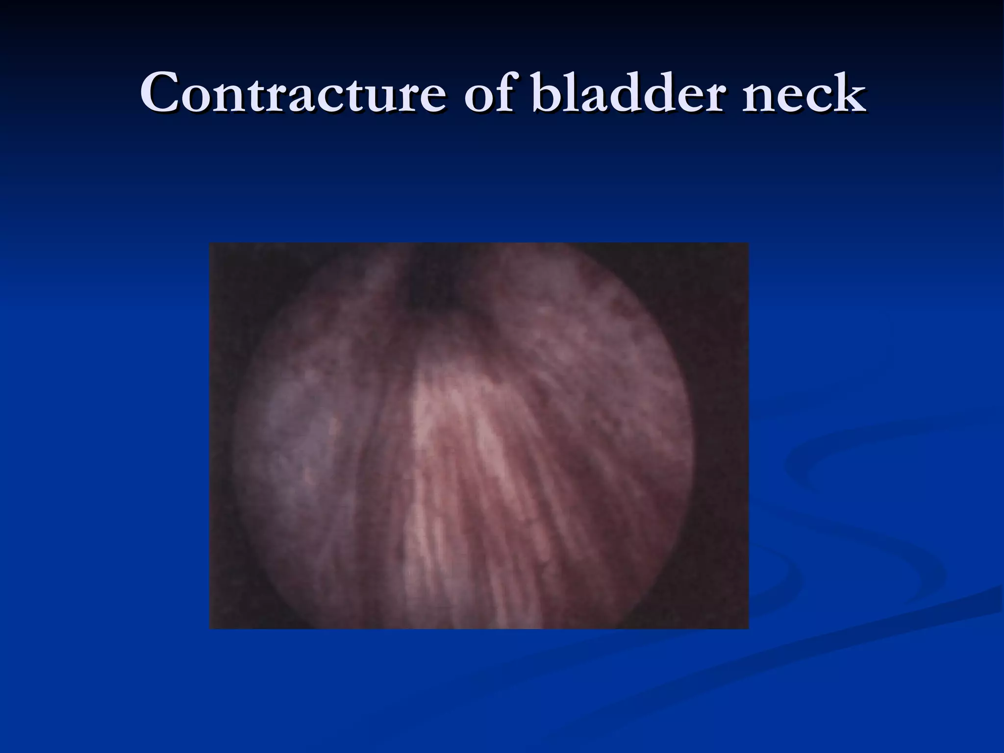 Urinary Outflow Obstruction | PPT