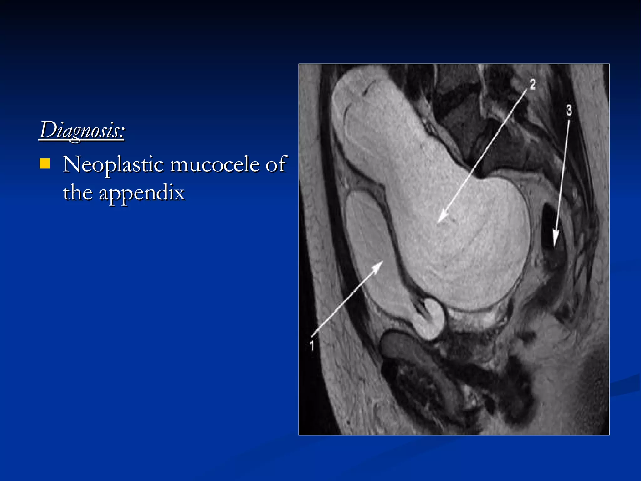 Urinary Outflow Obstruction | PPT