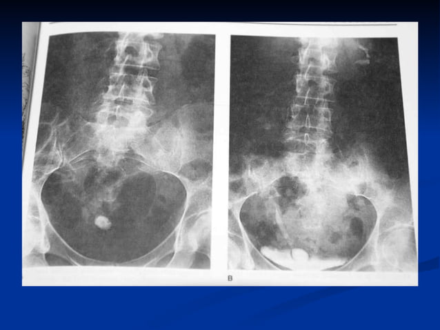 Urinary Outflow Obstruction | PPT