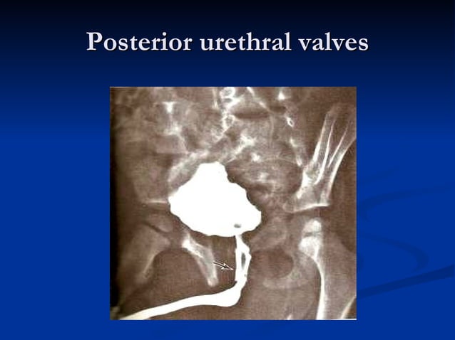 Urinary Outflow Obstruction | PPT