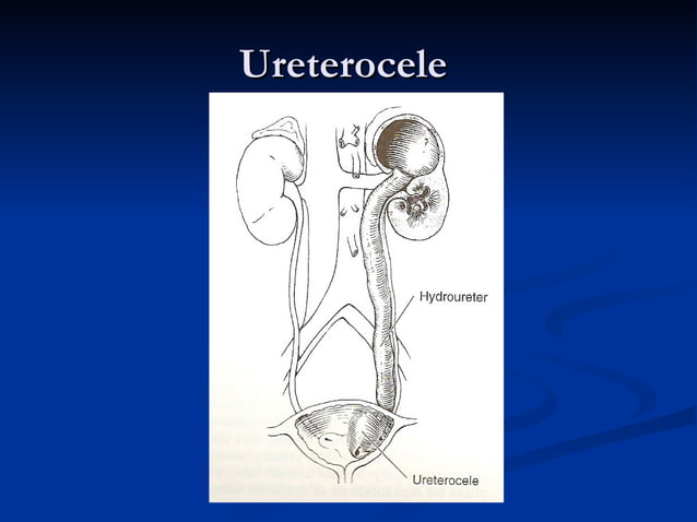 Urinary Outflow Obstruction | PPT