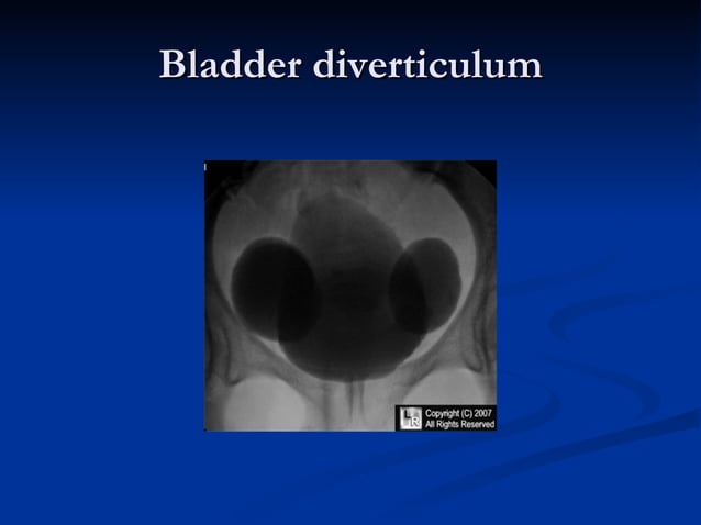 Urinary Outflow Obstruction | PPT