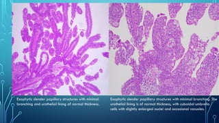 urinary bladder nonneoplastic and neoplastic | PPTX
