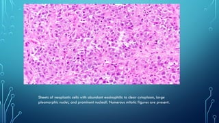 urinary bladder nonneoplastic and neoplastic | PPTX