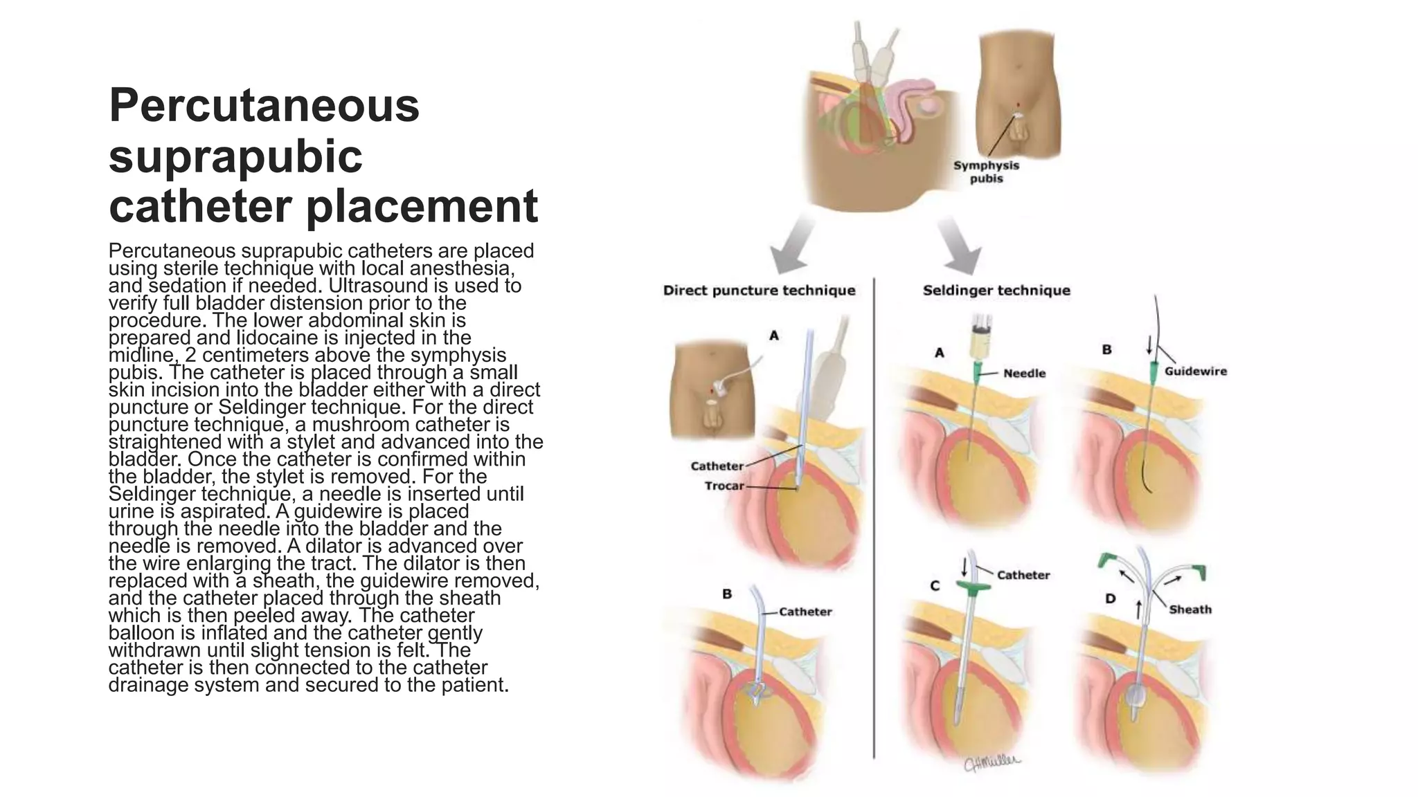 Urinary bladder catheters aaron | PPTX