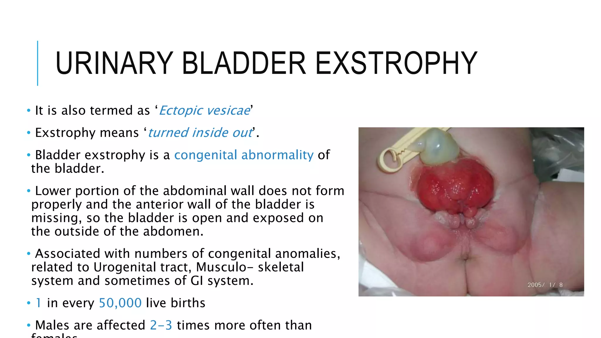 Urinary Bladder Exstrophy.pptx