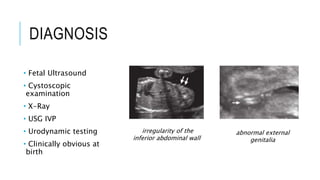 Urinary Bladder Exstrophy.pptx