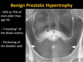 Urinary bladder pathologies | PPTX