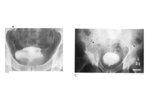 Urinary bladder pathology radiology | PPTX