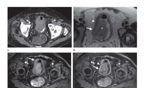 Urinary bladder pathology radiology | PPTX