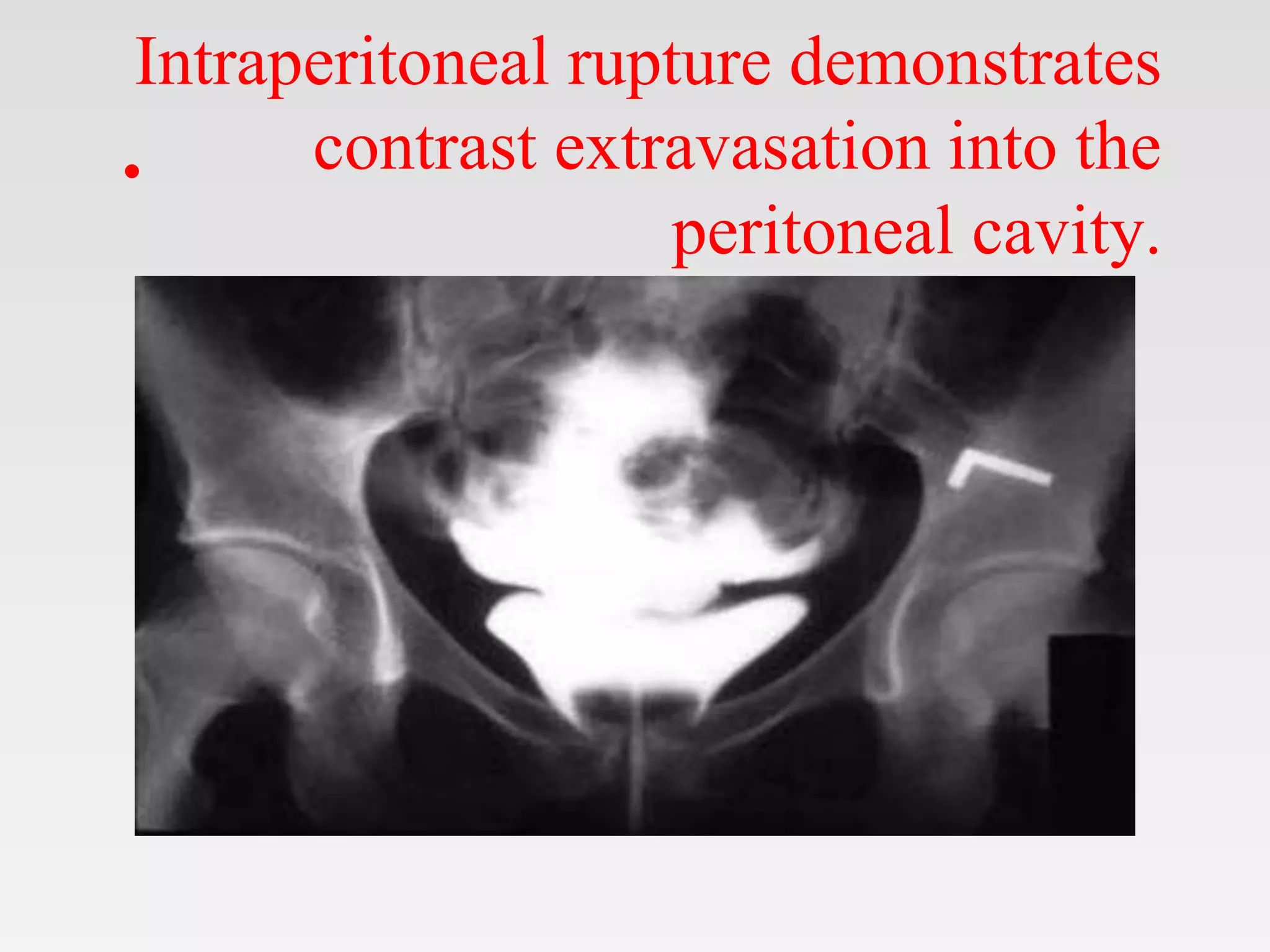 Urinary bladder trauma.pptx