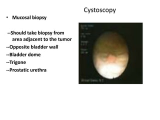 Urinary Bladder Tumor.ppt