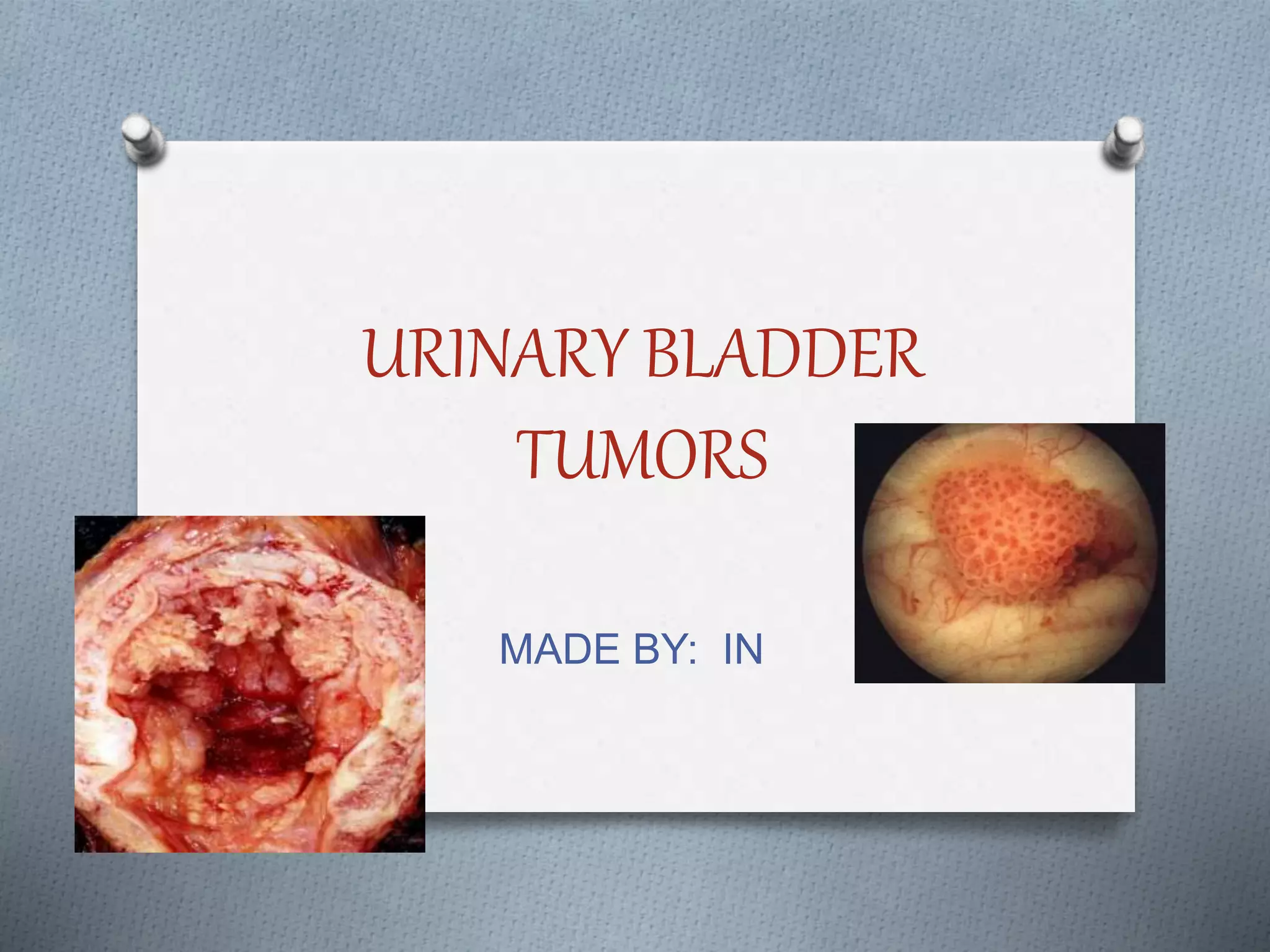 Urinary bladder tumors | PPTX