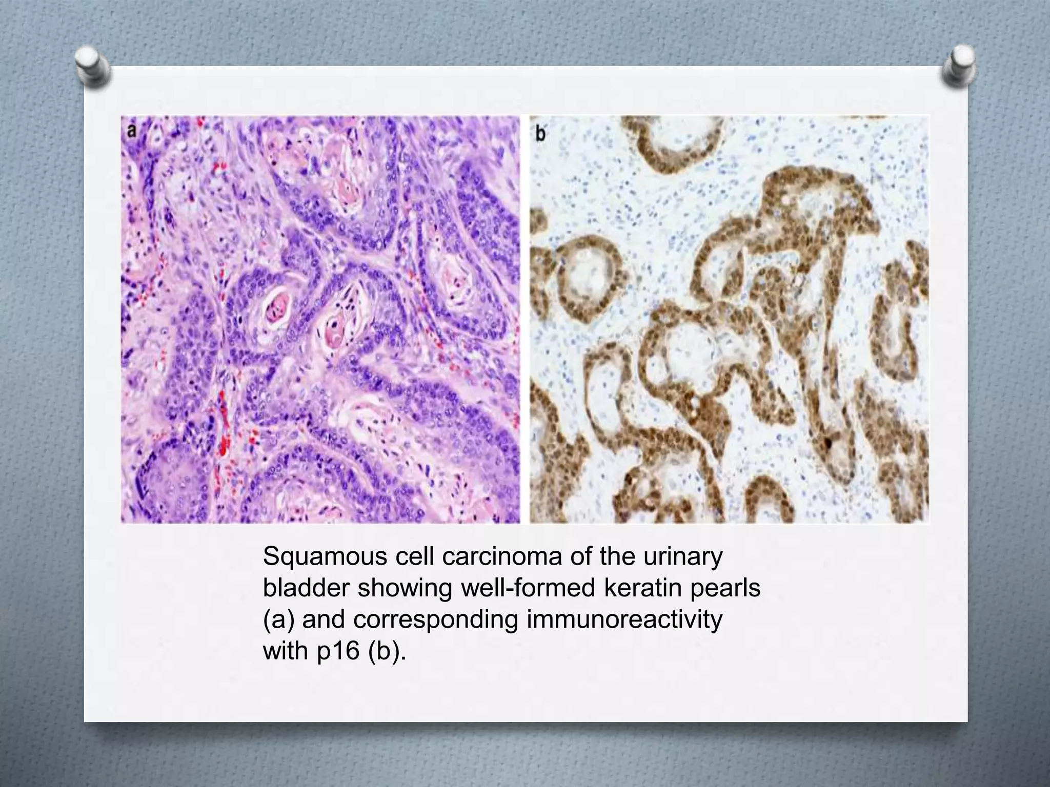 Urinary bladder tumors | PPTX