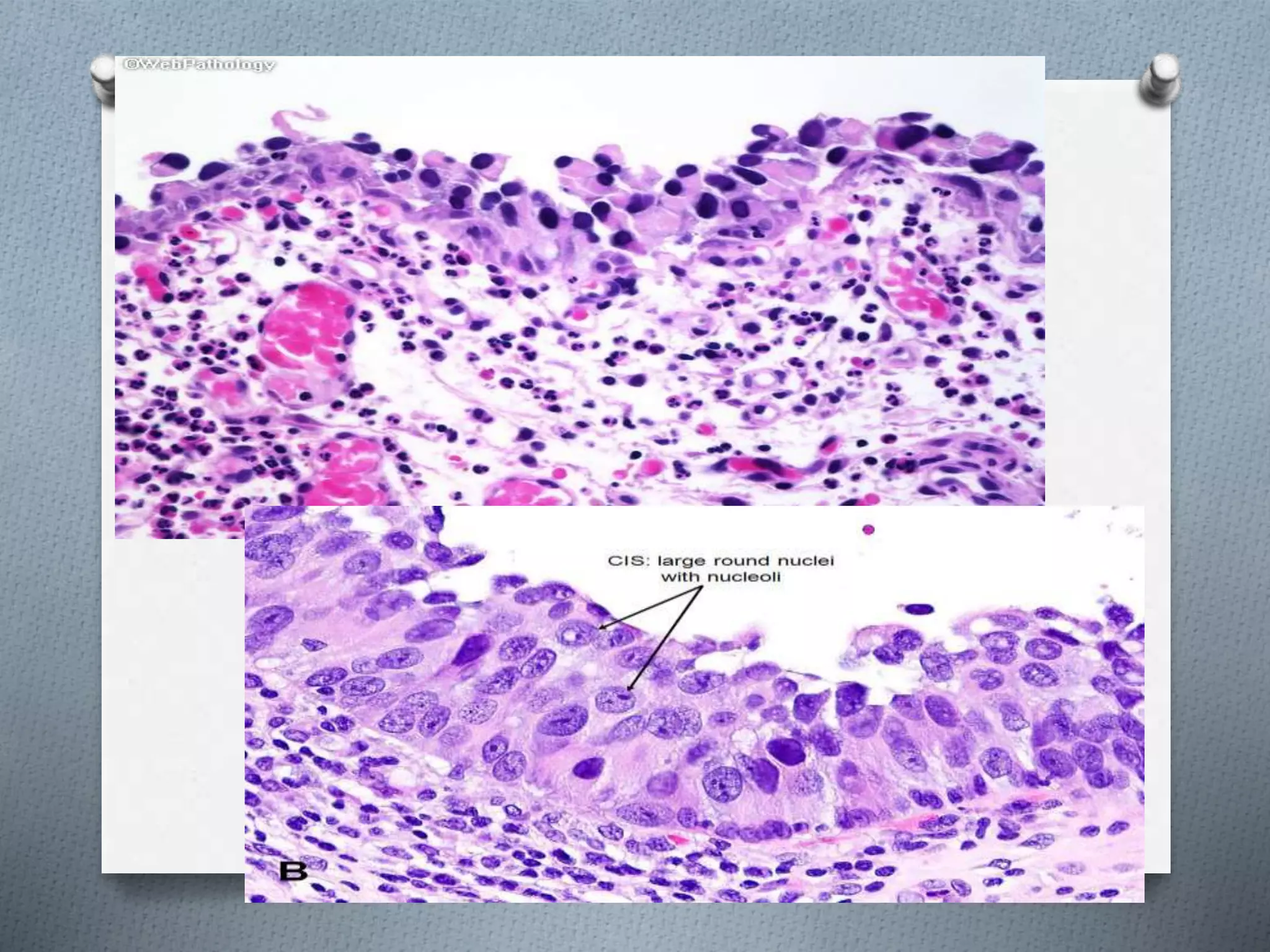 Urinary bladder tumors | PPTX