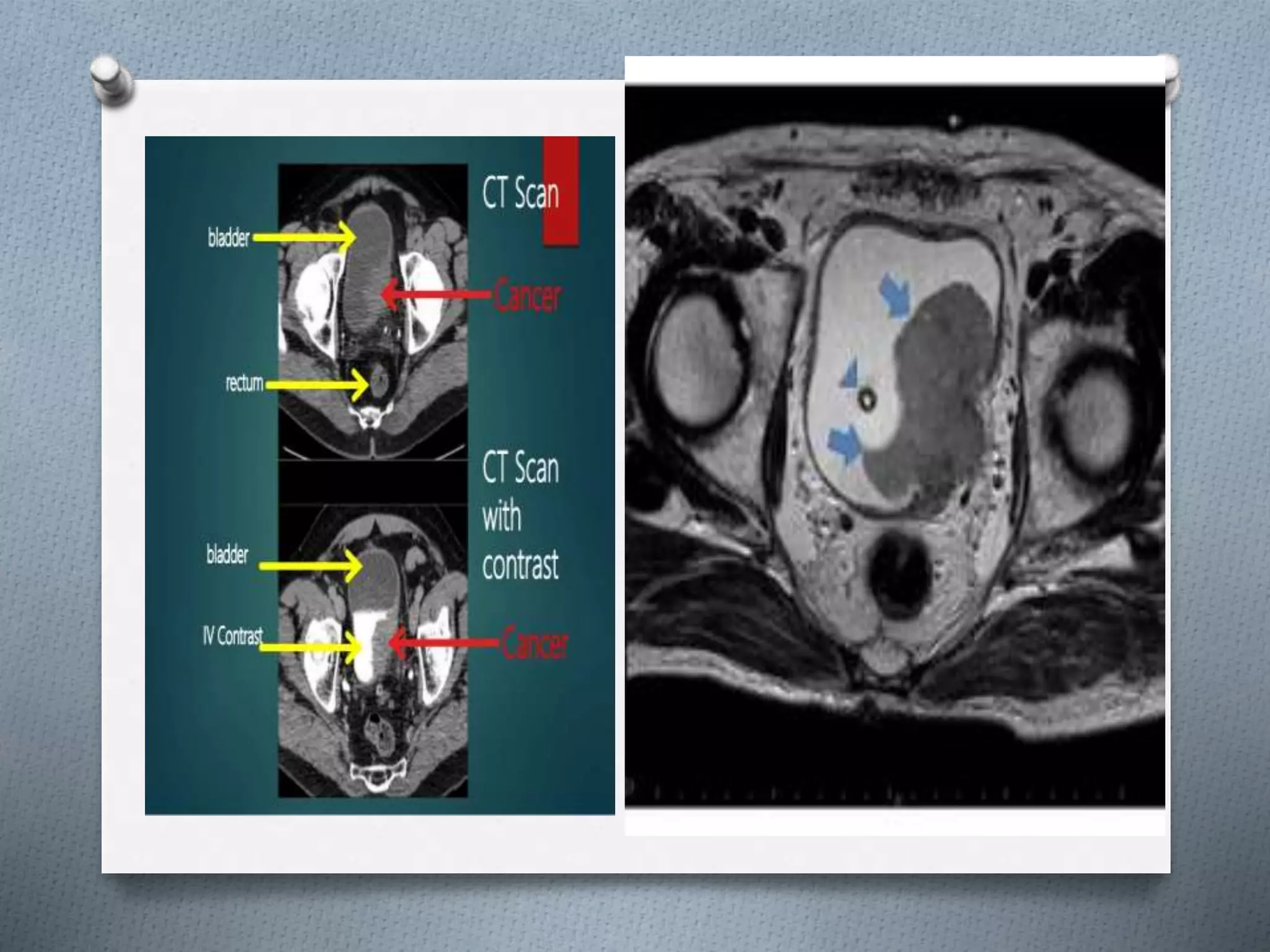 Urinary Bladder Tumors Ppt 