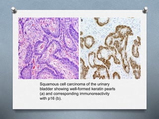 Urinary bladder tumors | PPTX
