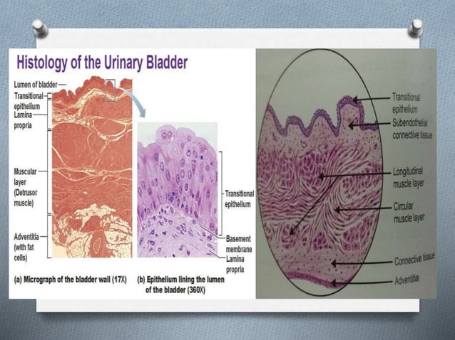 Urinary bladder tumors | PPTX | Cancer | Diseases and Conditions