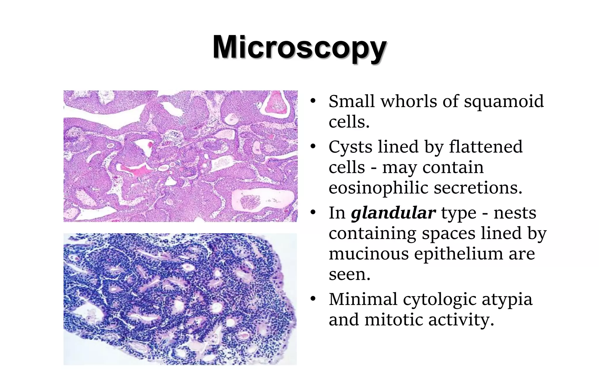 URINARY BLADDER TUMORS.pdf